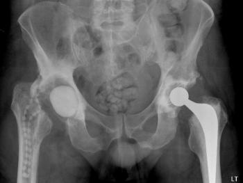 Reviews of the Stryker Exeter Hip